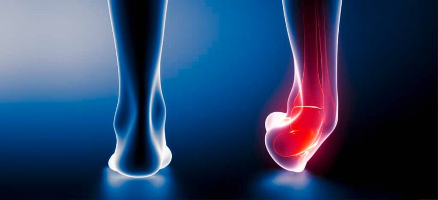 Stukad fotled - Tips och skydd vid stukad fot | Gå & Löpkliniken