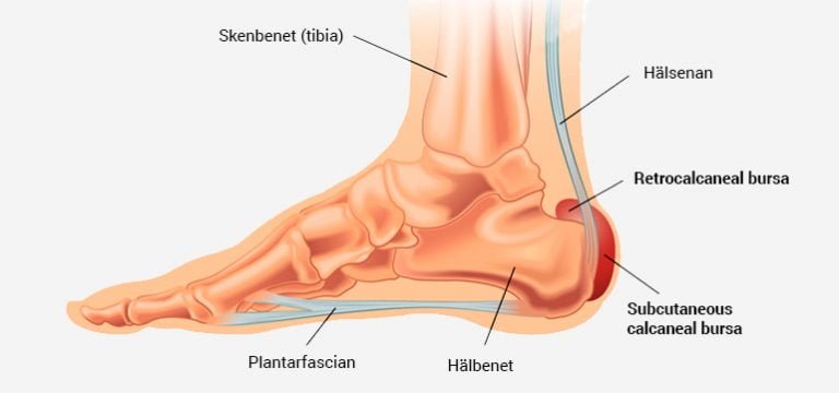 Bursit - Tips och råd vid slemsäcksinflammation | Gå & Löpkliniken